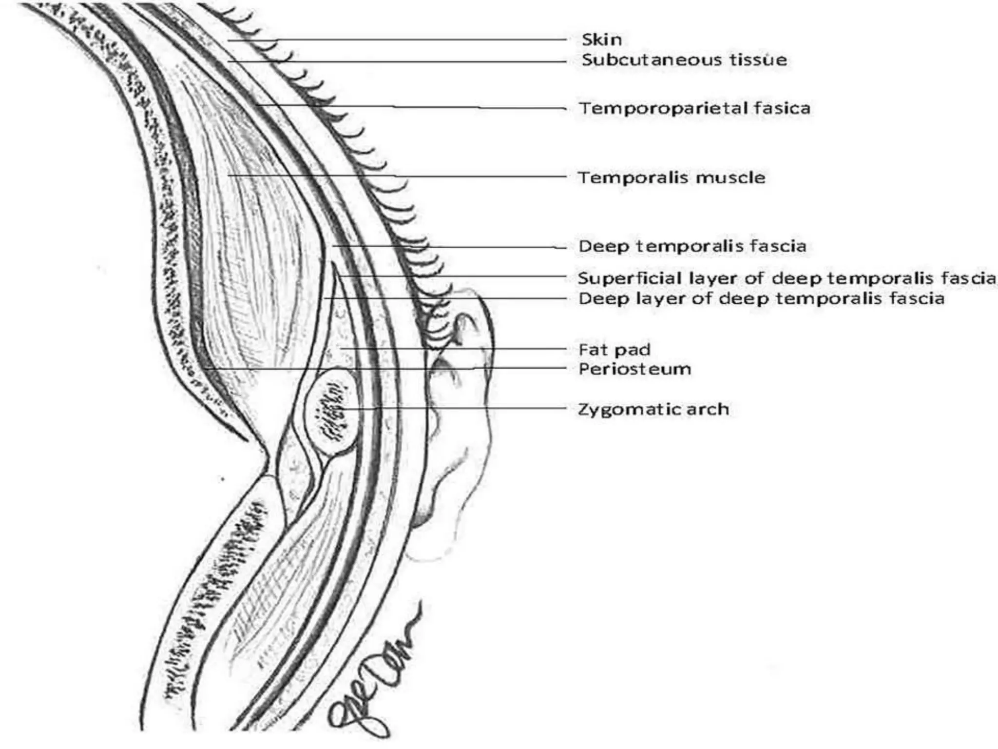 Temporalis muscle flap | PPTX
