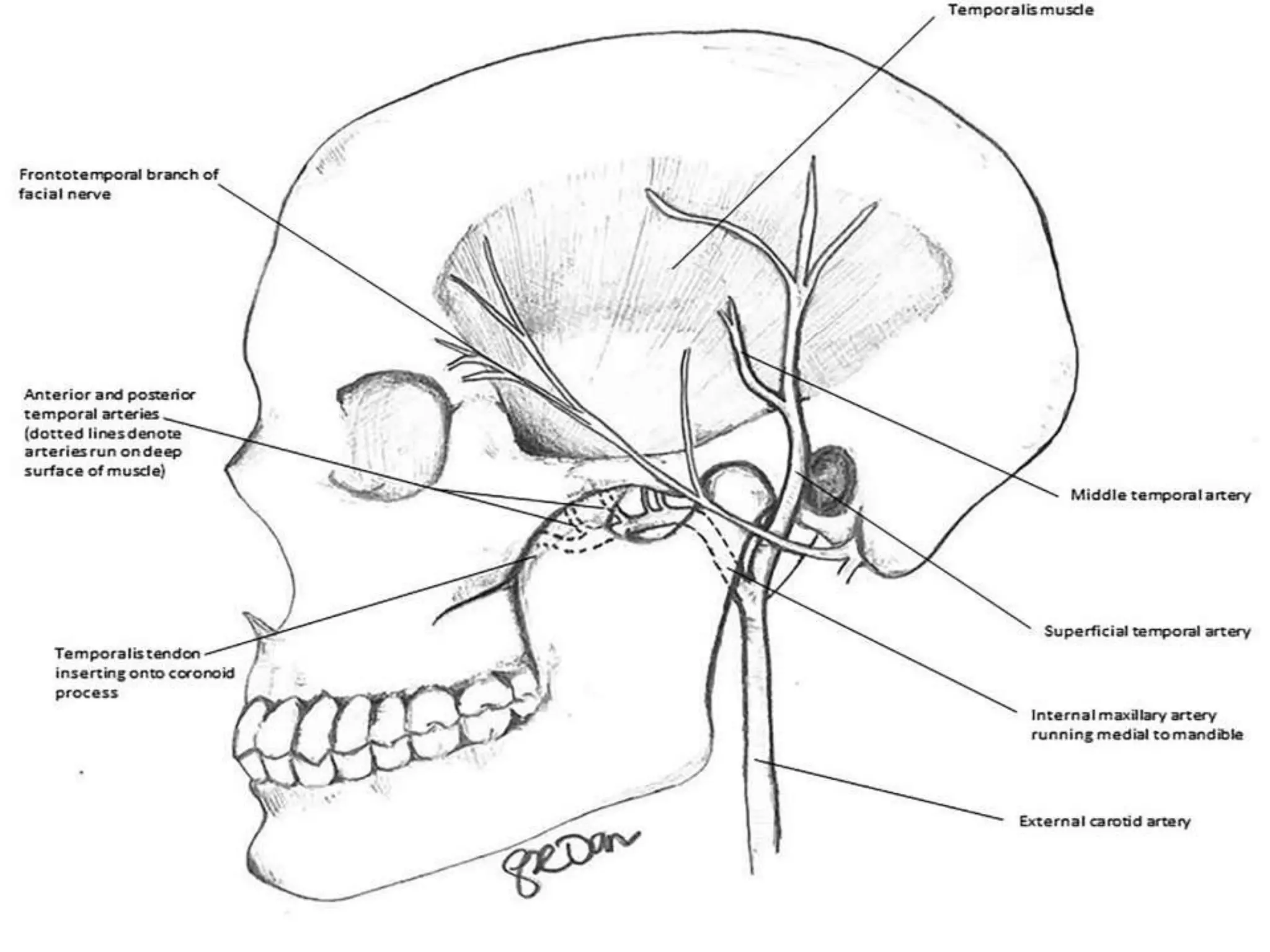 Temporalis muscle flap | PPTX