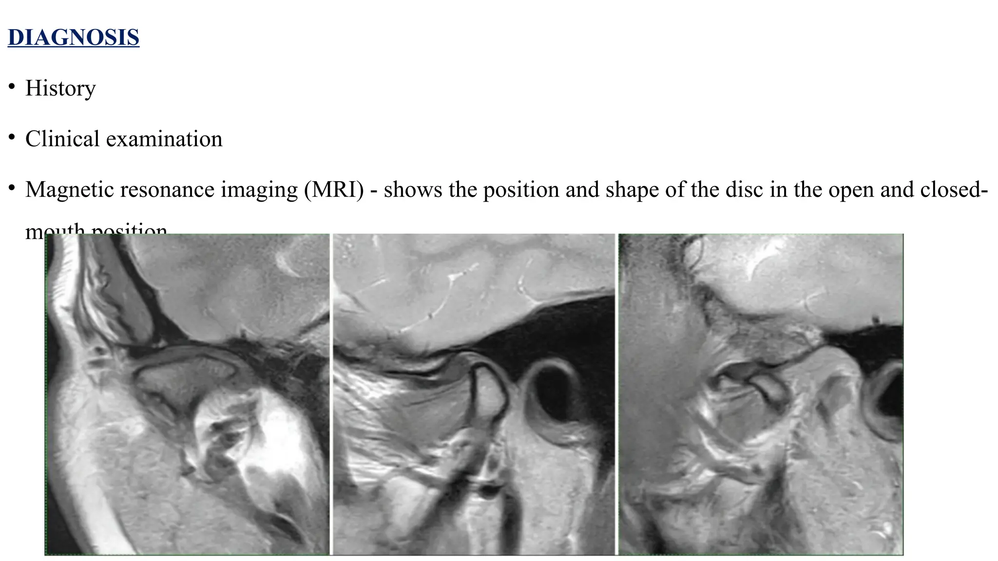 temporalis myofasial flap in internal derangement of the ...