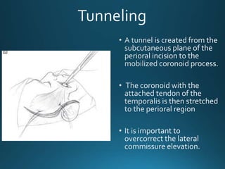 Temporalis transfer for unilateral facial nerve palsy for smile ...