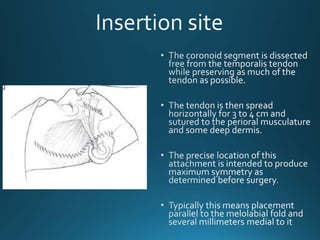 Temporalis transfer for unilateral facial nerve palsy for smile ...