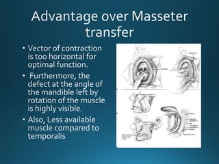 Temporalis transfer for unilateral facial nerve palsy for smile ...
