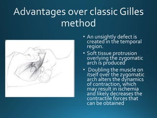 Temporalis transfer for unilateral facial nerve palsy for smile ...