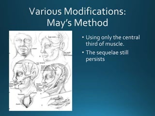 Temporalis transfer for unilateral facial nerve palsy for smile ...