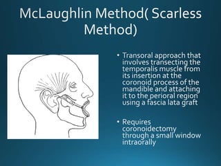 Temporalis transfer for unilateral facial nerve palsy for smile ...