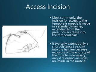 Temporalis transfer for unilateral facial nerve palsy for smile ...