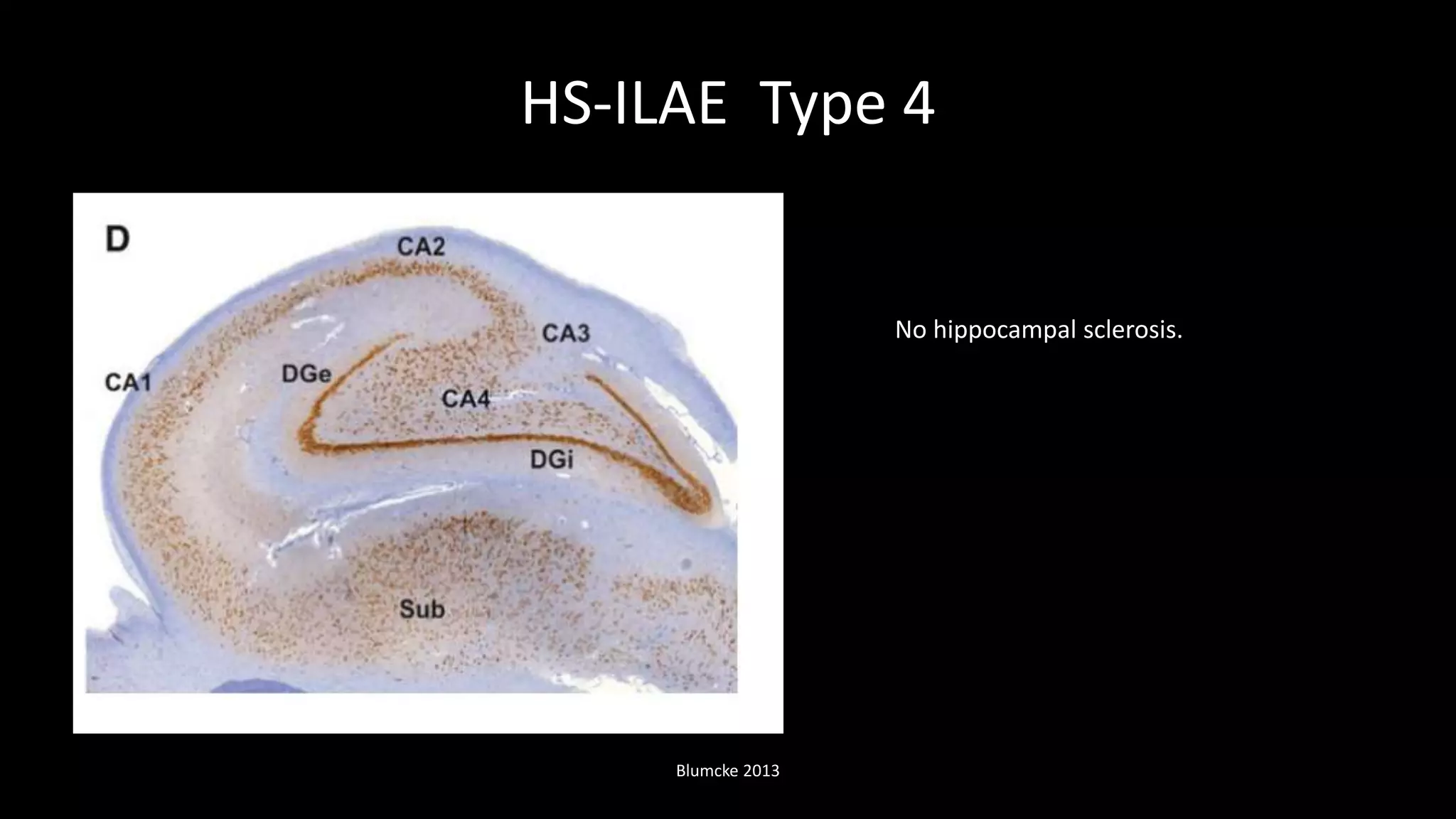Temporal Lobe Epilepsy Pptx