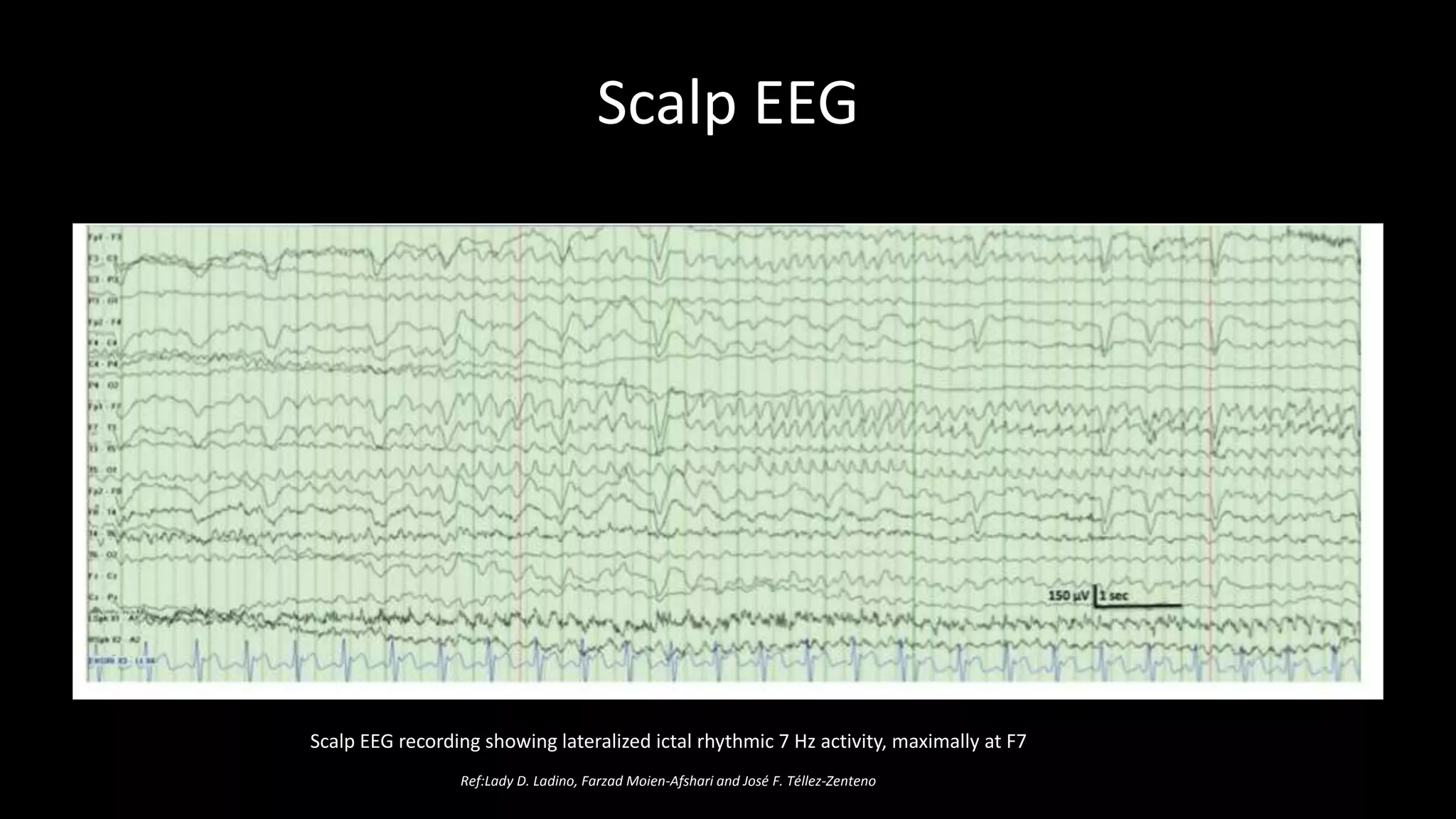Temporal Lobe Epilepsy Pptx