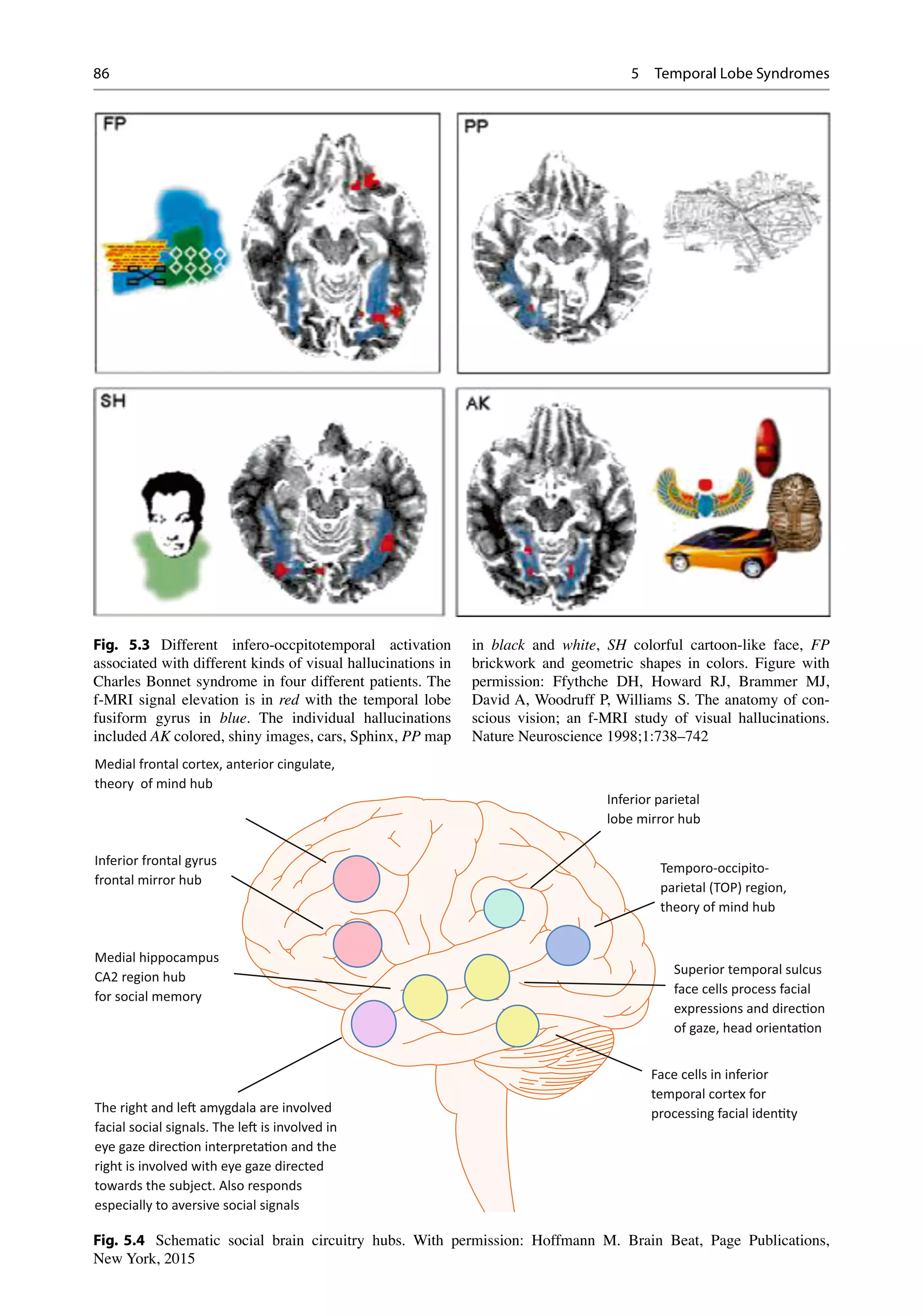 temporal lobe syndrome.pdf | Brain and Nervous System Disorders ...