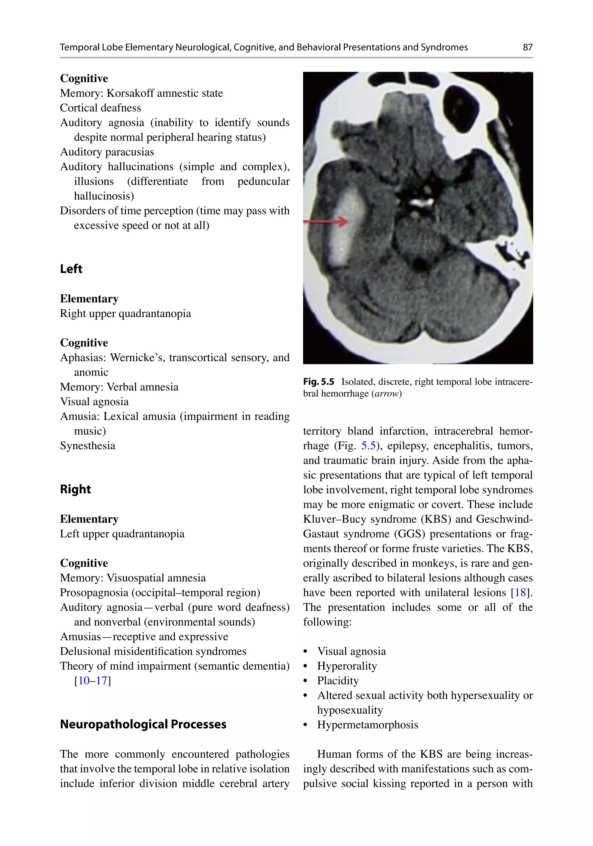 temporal lobe syndrome.pdf | Brain and Nervous System Disorders | Diseases and Conditions