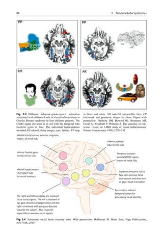 temporal lobe syndrome.pdf | Brain and Nervous System Disorders | Diseases and Conditions