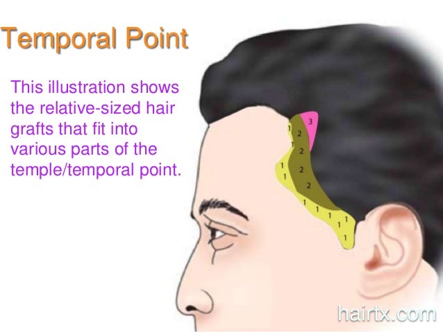 Dallas Hair Transplant Temporal Point Design