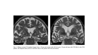 Temporal stem anatomy | PPT