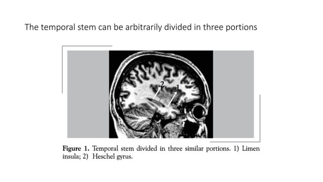 Temporal stem anatomy | PPT