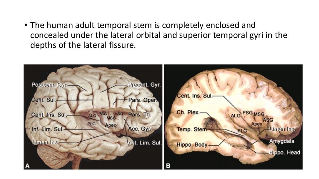 Temporal stem anatomy