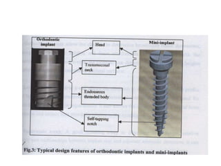 Temporary Anchorage devices.pptx