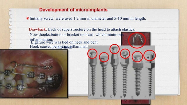 Temporary Anchorage Device (TAD's) | PPTX