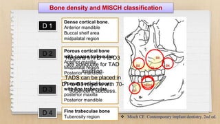 Temporary Anchorage Device (TAD's) | PPT