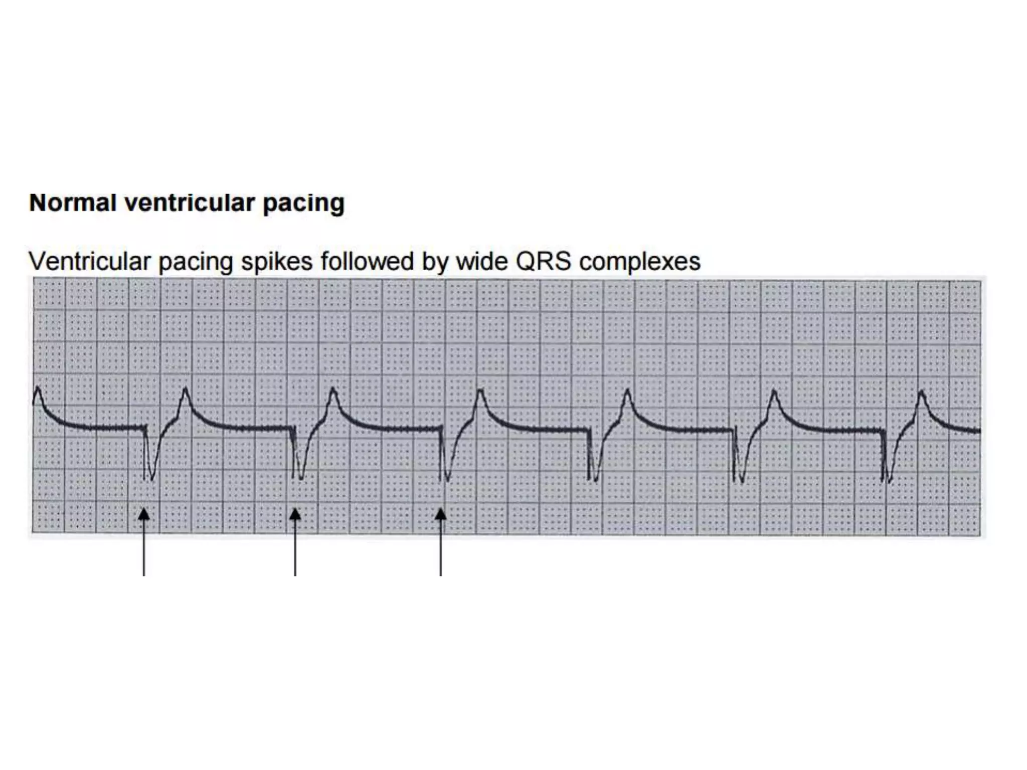 Temporary cardiac pacing | PPTX