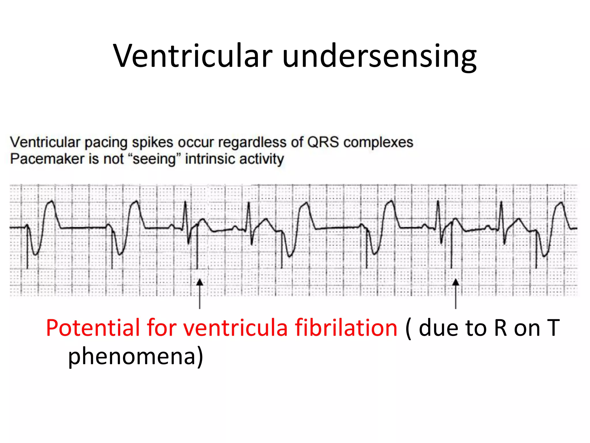 Temporary cardiac pacing | PPTX