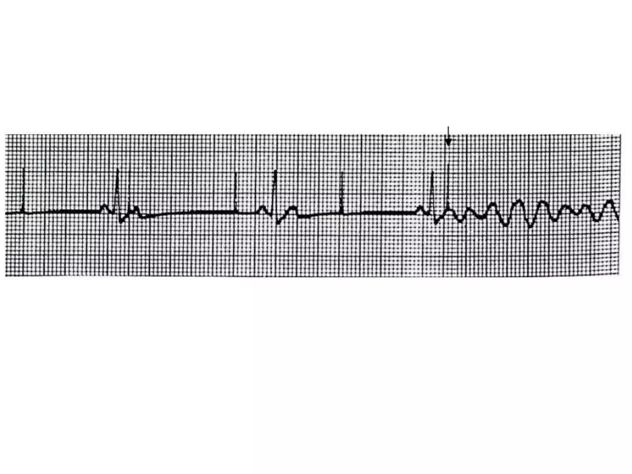 Temporary cardiac pacing | PPTX