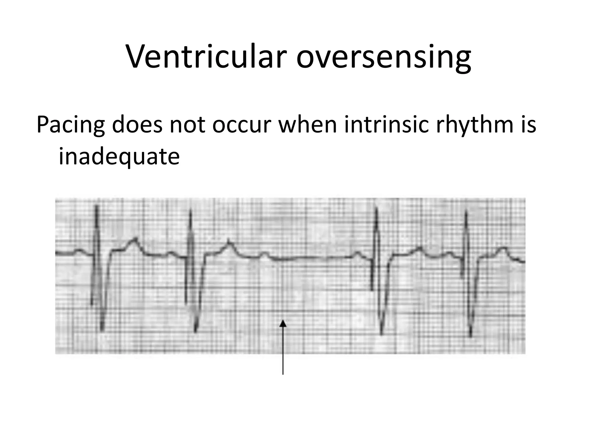 Temporary cardiac pacing | PPTX