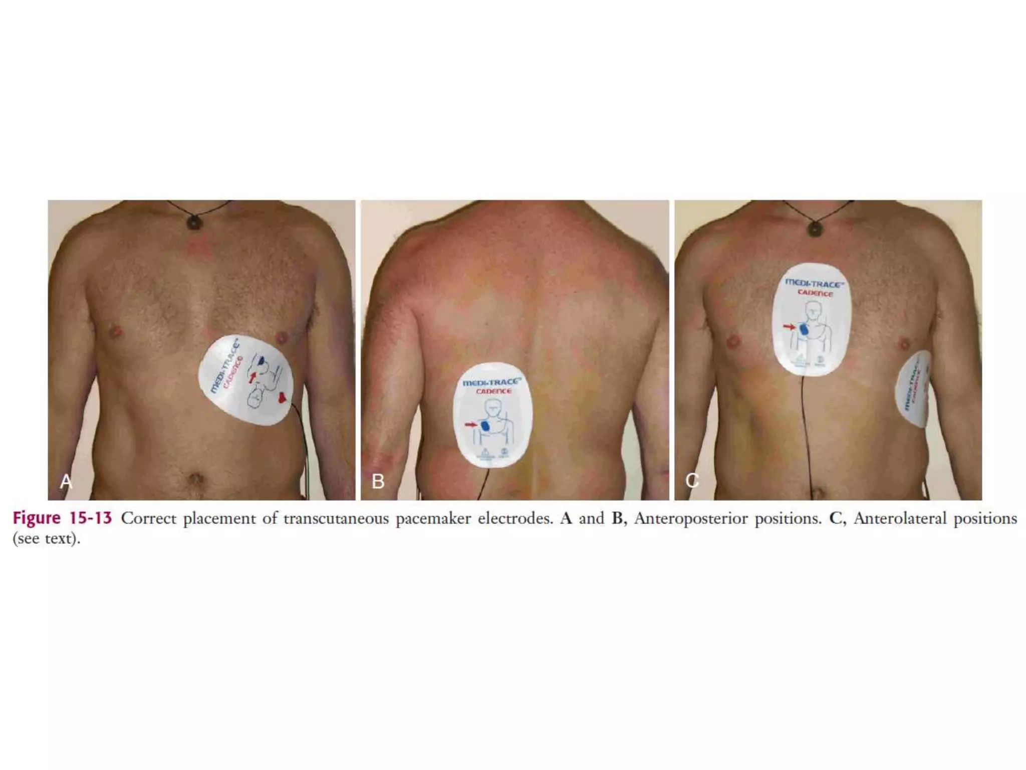 Temporary cardiac pacing | PPTX