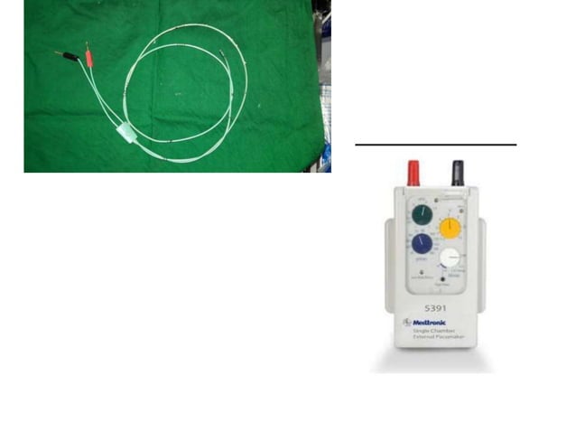 Temporary cardiac pacing | PPTX