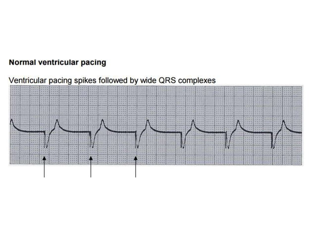 Temporary cardiac pacing | PPTX