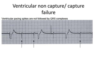 Temporary cardiac pacing | PPTX