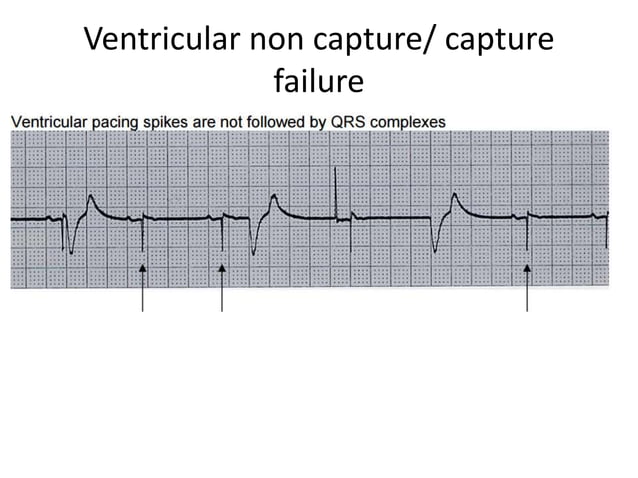 Temporary cardiac pacing | PPTX