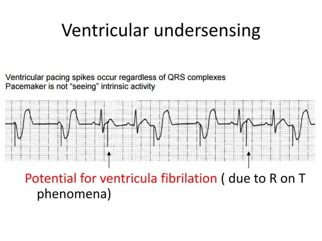 Temporary cardiac pacing | PPTX
