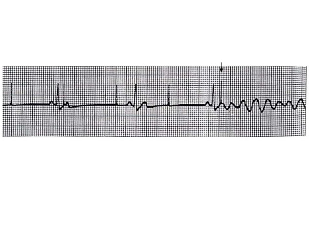 Temporary cardiac pacing | PPTX