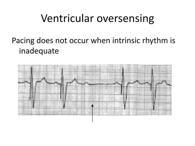 Temporary cardiac pacing | PPTX