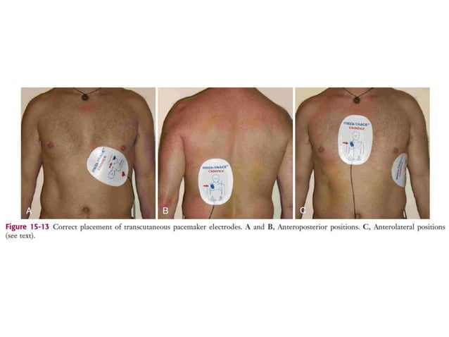 Temporary cardiac pacing | PPT