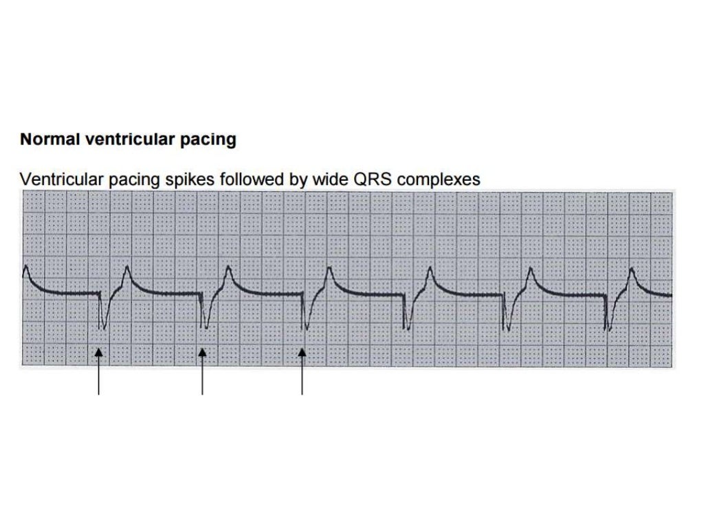 Temporary cardiac pacing