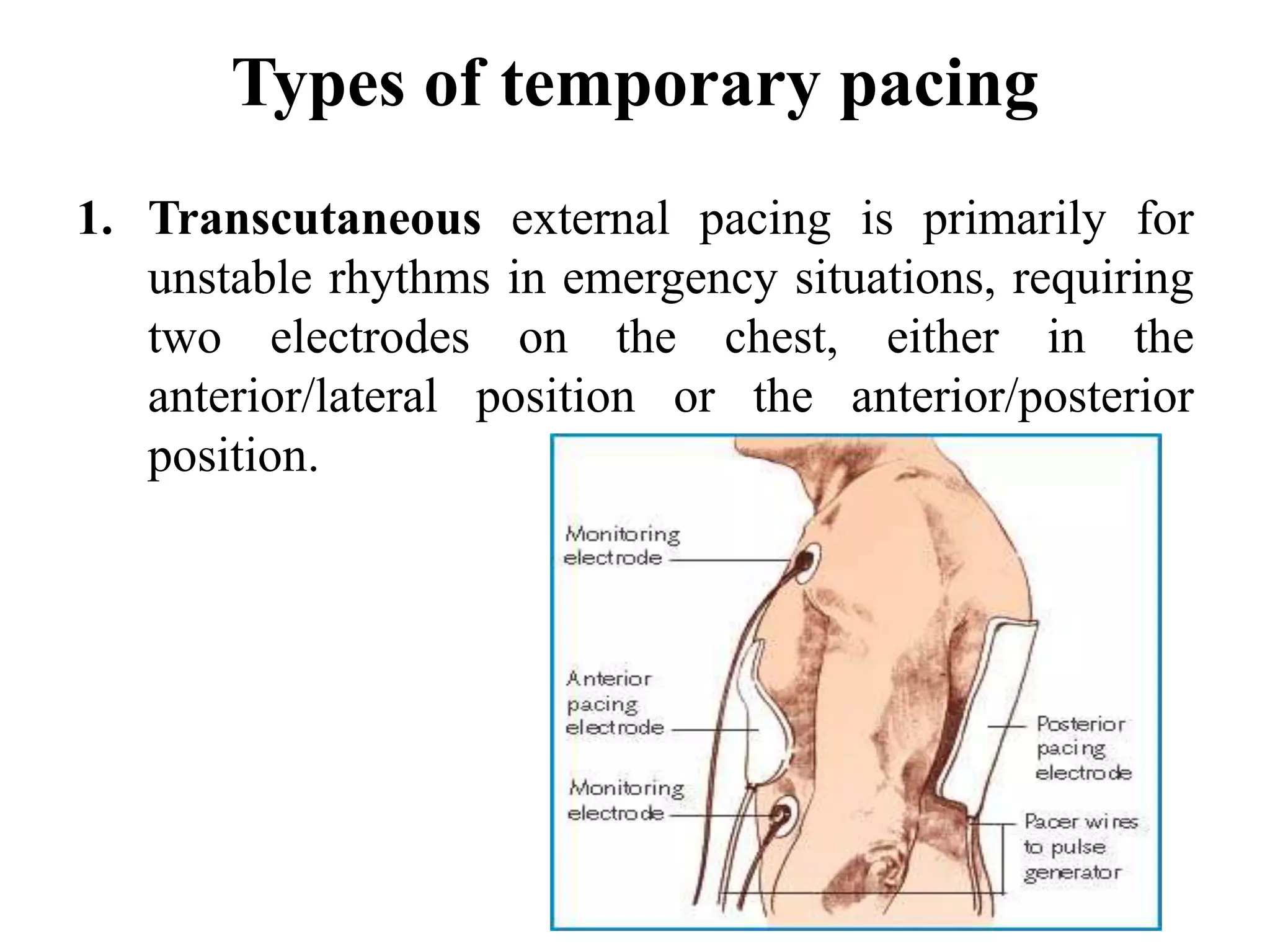 Temporary cardiac pacing | PPTX