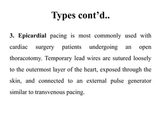 Temporary cardiac pacing | PPTX