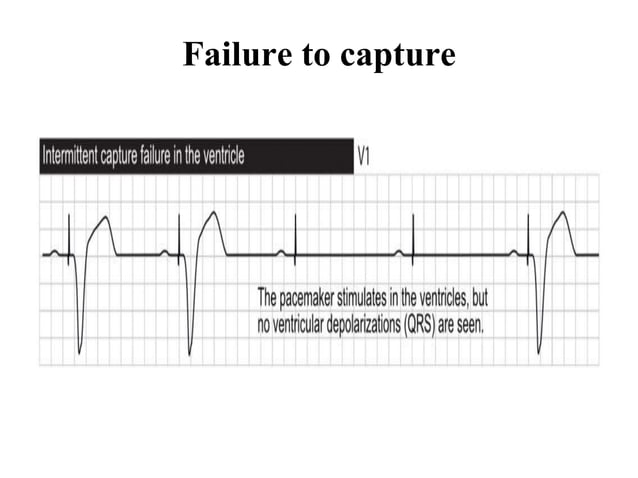 Temporary cardiac pacing | PPTX | First Aid | Injuries