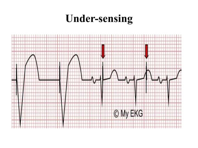 Temporary cardiac pacing | PPTX | First Aid | Injuries