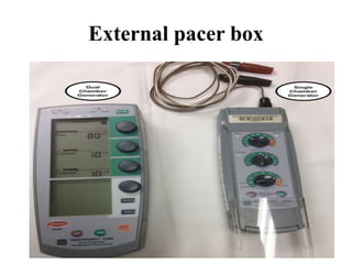 Temporary cardiac pacing | PPTX