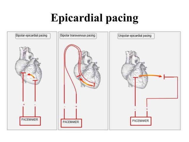 Temporary cardiac pacing