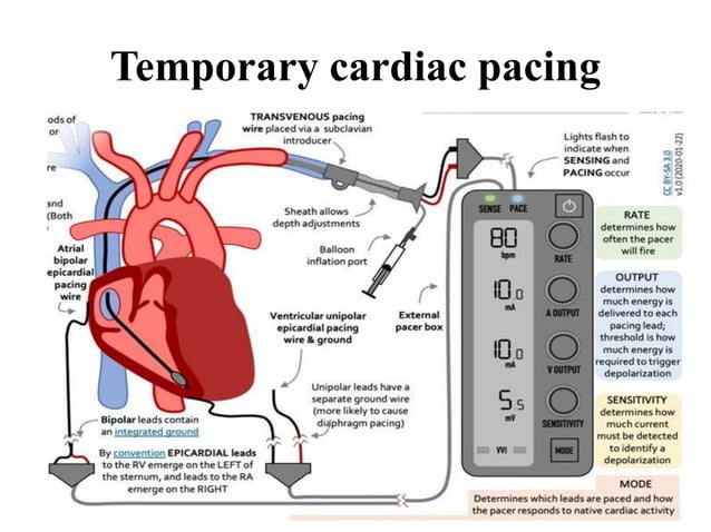 Temporary cardiac pacing