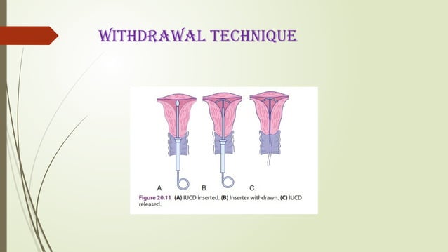 TEMPORARY CONTRACEPTION choice, methods.pptx