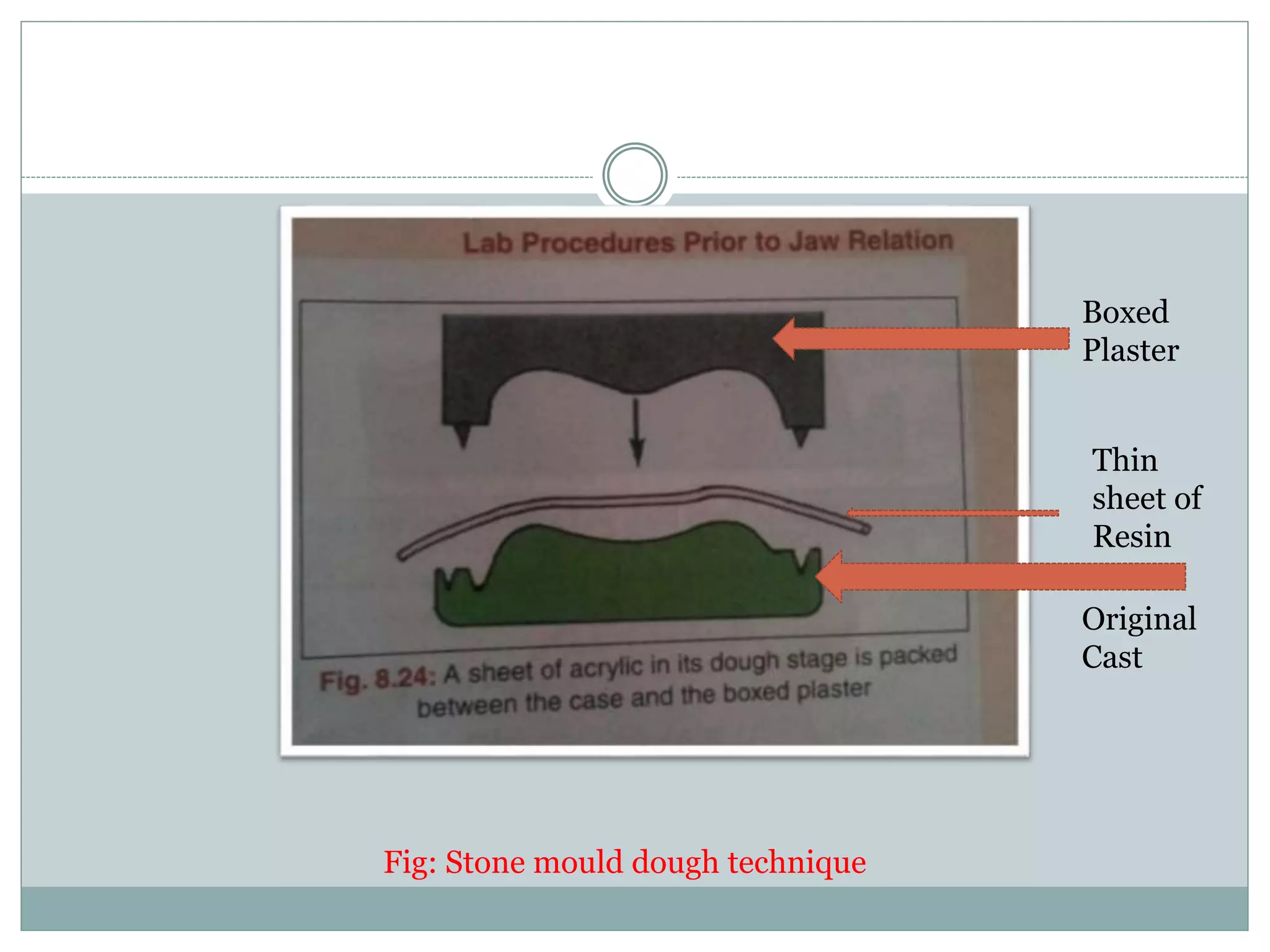 Temporary denture base | PPTX