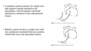 temporary epicardial pacing in cardiac surgery.pptx