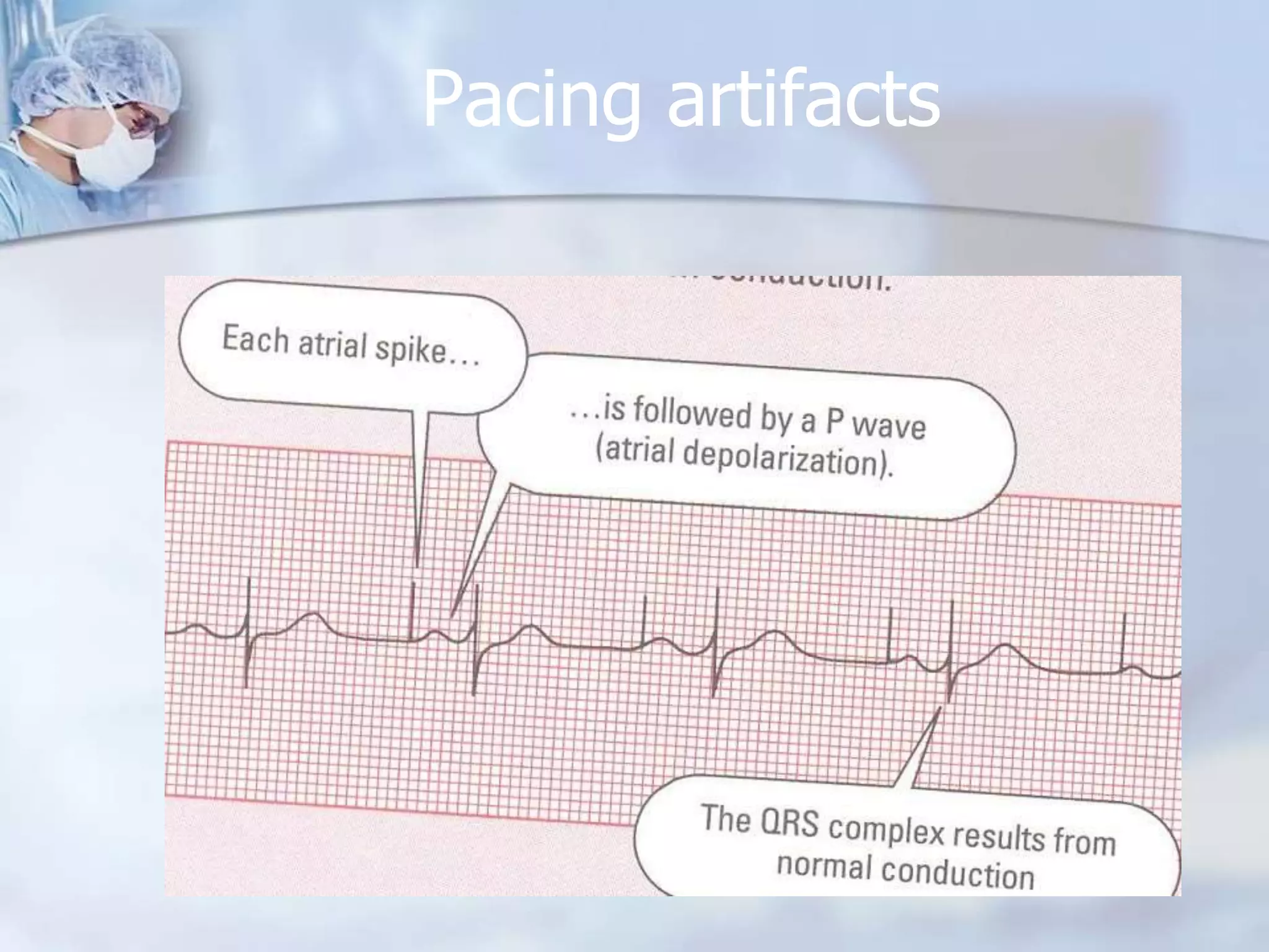 Temporary Pacemaker.pptx
