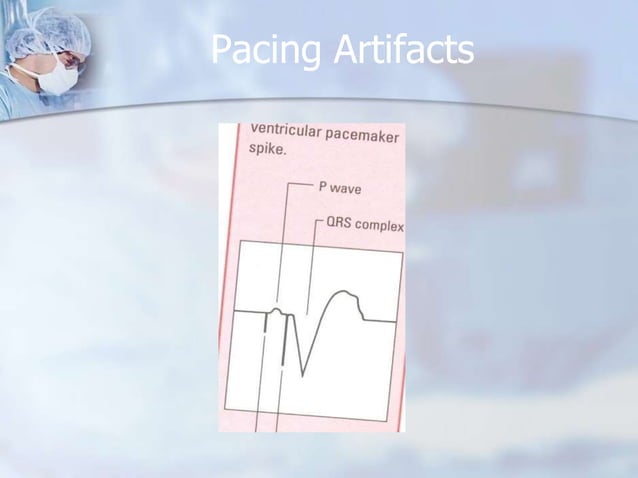 Temporary Pacemaker.pptx | Heart and Cardiovascular Diseases | Diseases and Conditions