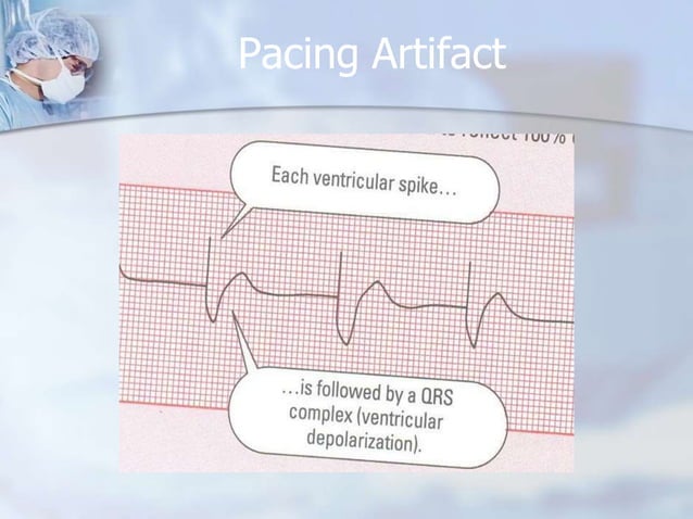 Temporary Pacemaker.pptx | Heart and Cardiovascular Diseases | Diseases ...