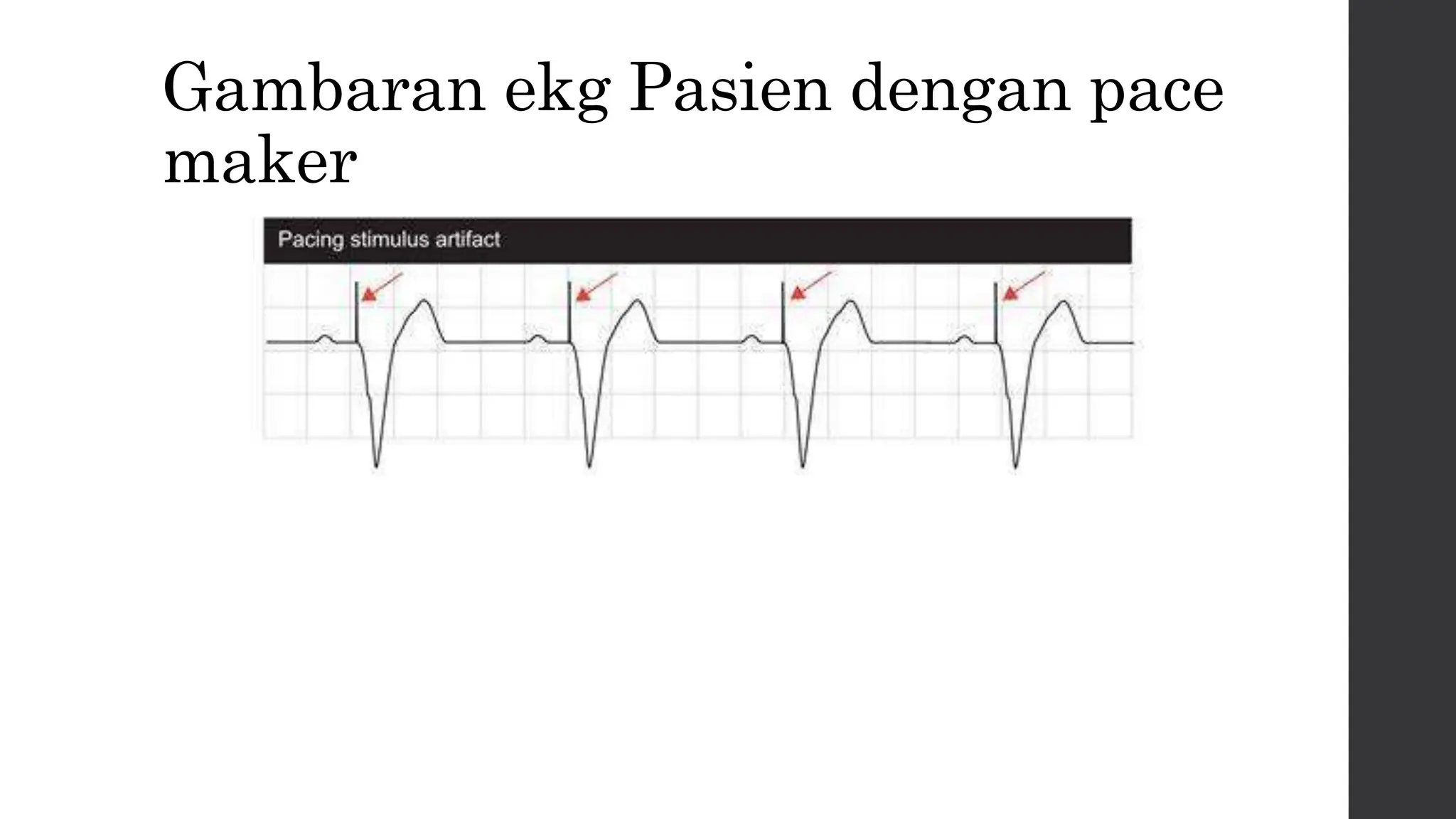 Temporary Pace Maker.pptx